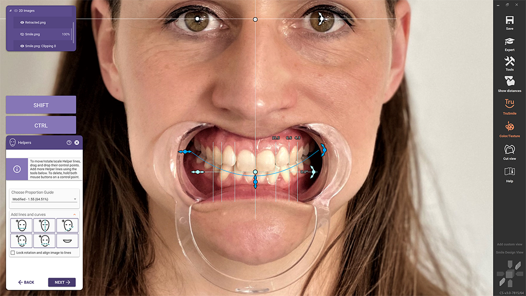 Smile Creator - exocad