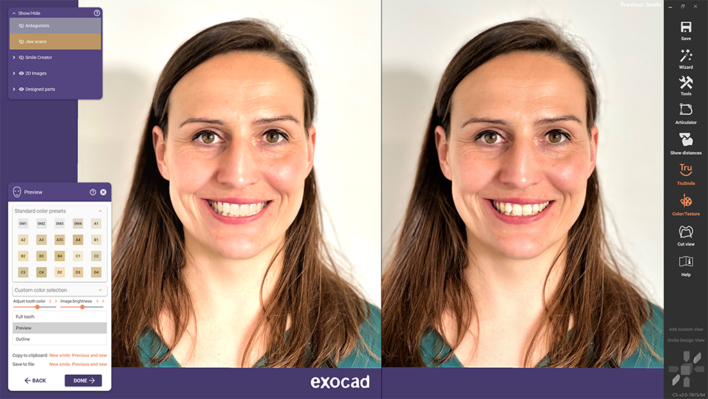 Smile Creator - exocad