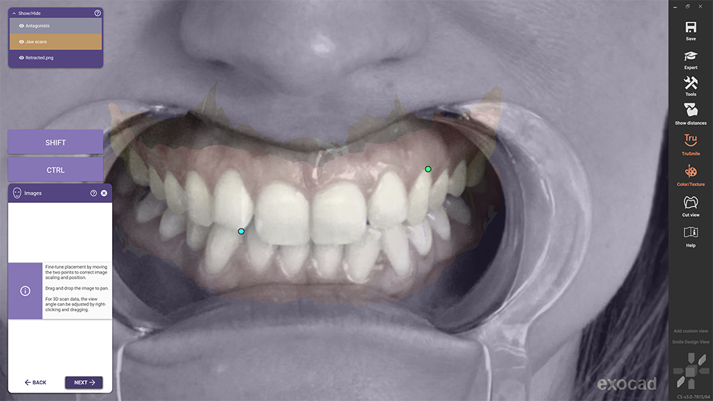 Smile Creator - exocad