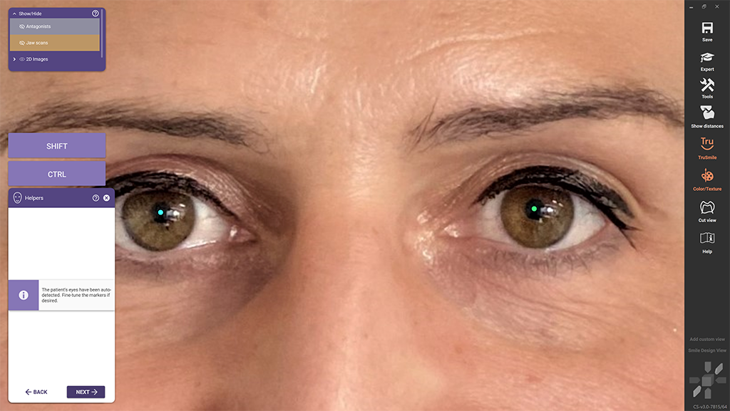 Smile Creator - exocad