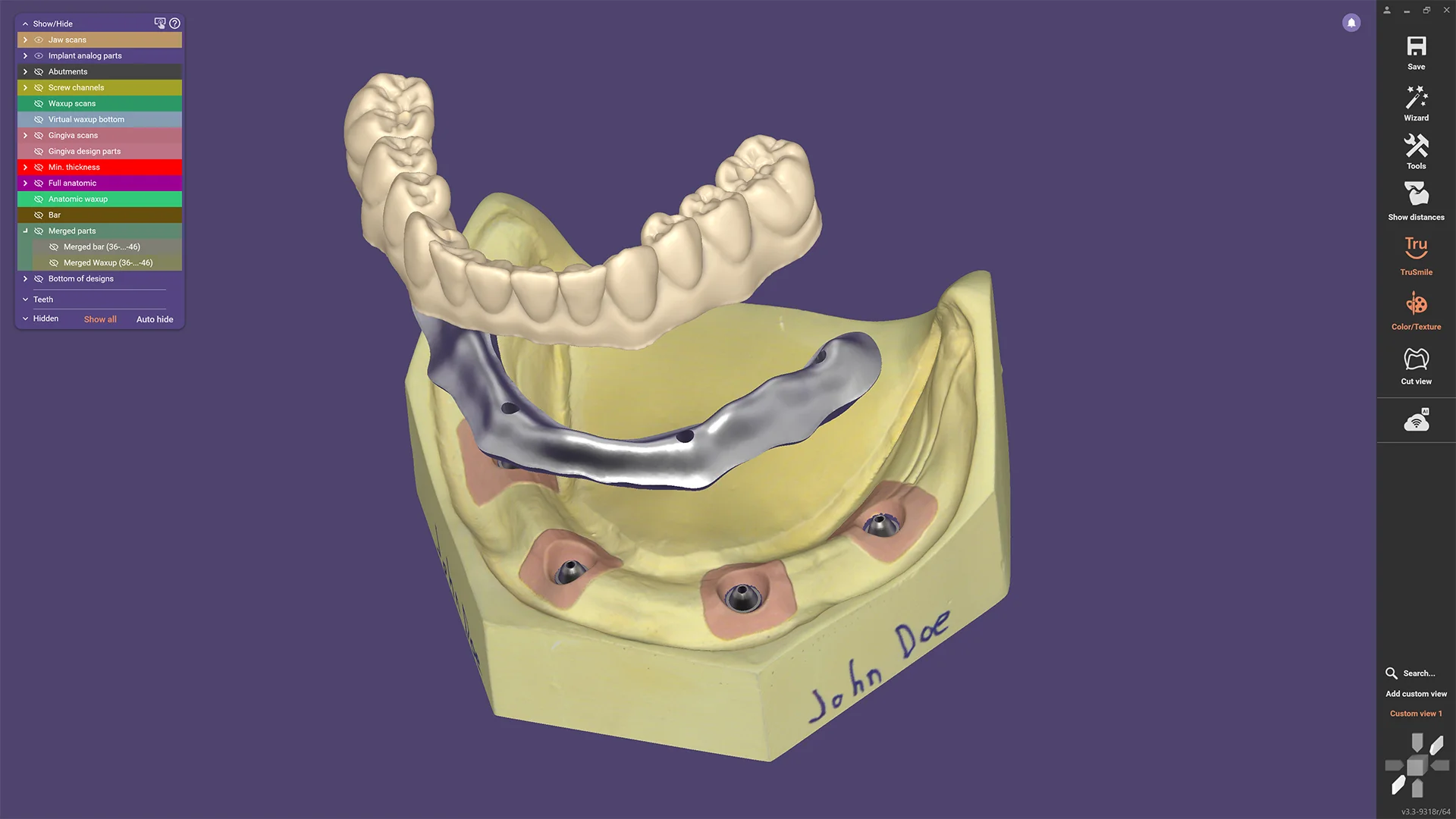 DentalCAD 3.3 Chemnitz - exocad